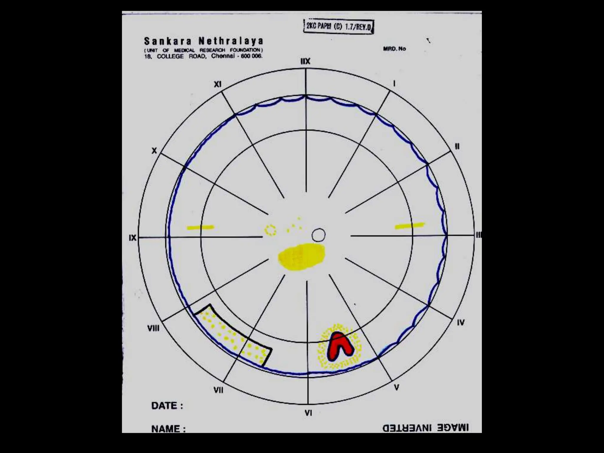 1FUNDUS_DRAWING of retina after complete examination | PPT