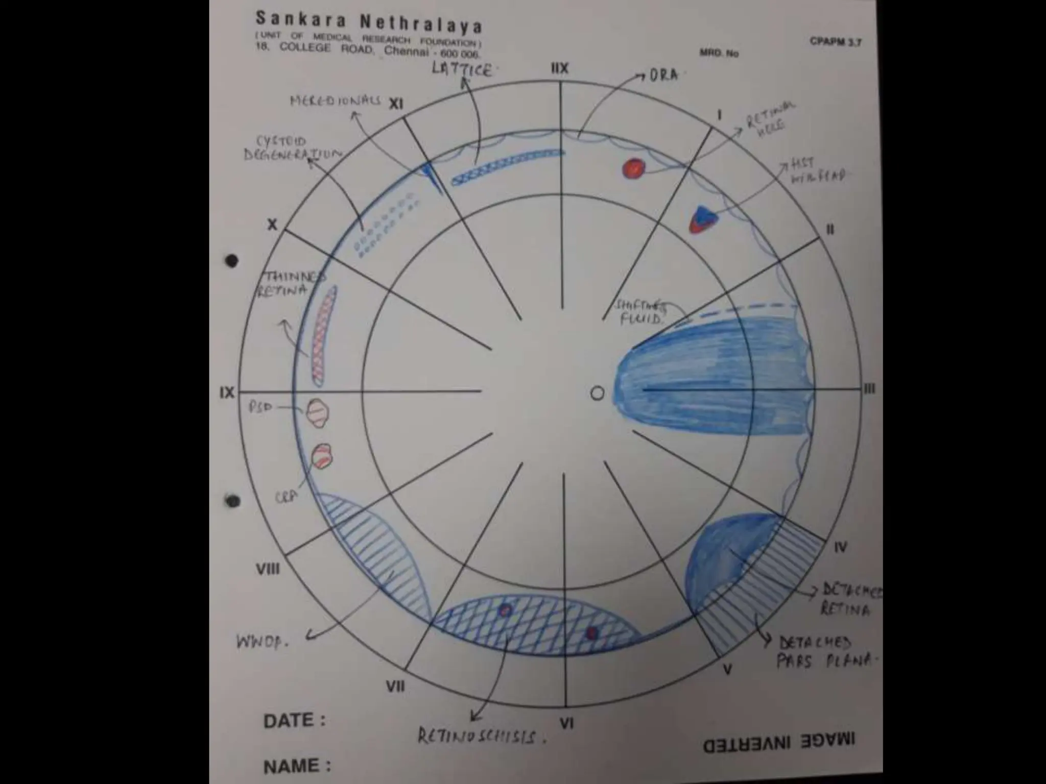 1FUNDUS_DRAWING of retina after complete examination | PPT