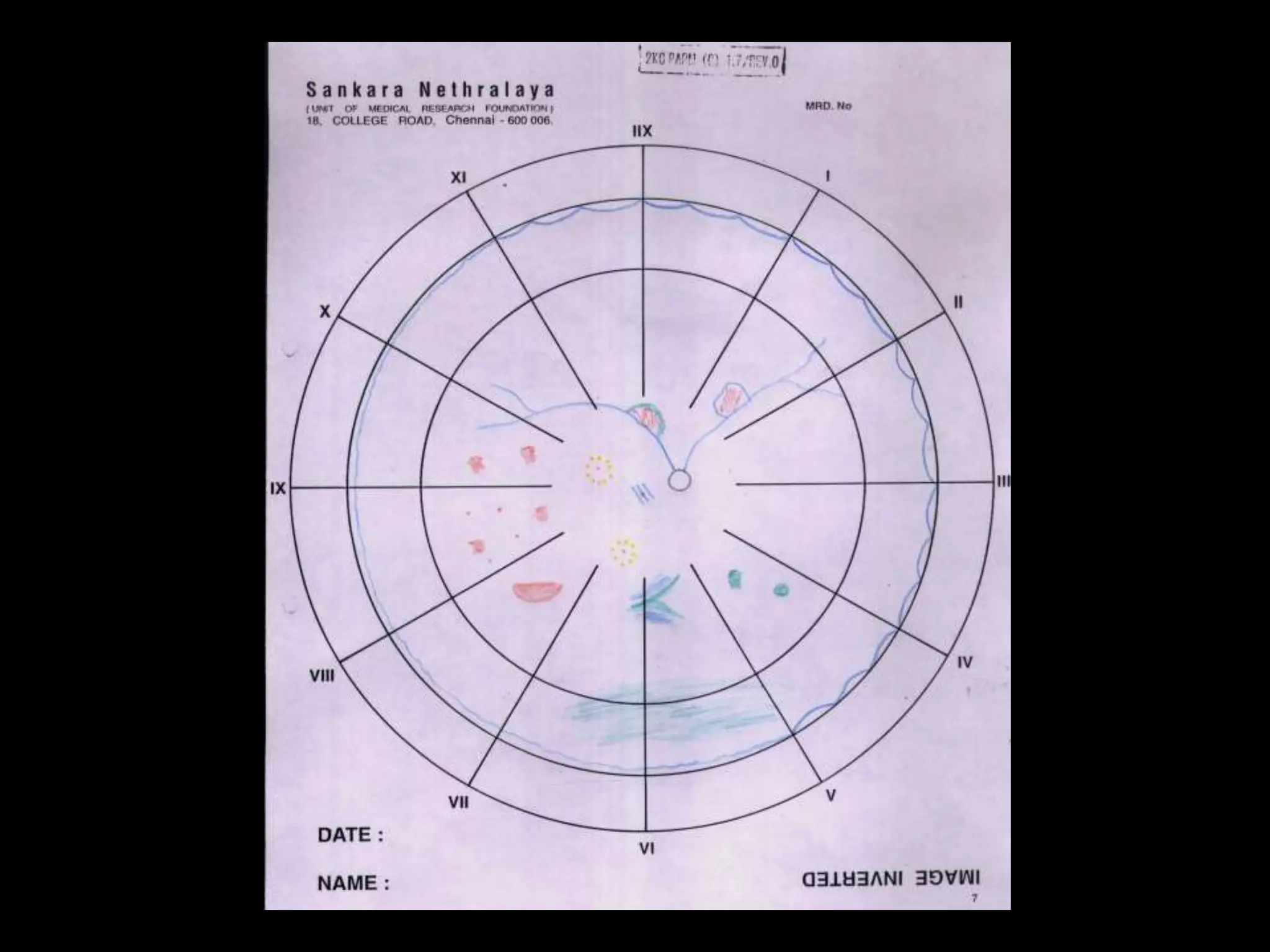 1FUNDUS_DRAWING of retina after complete examination | PPT