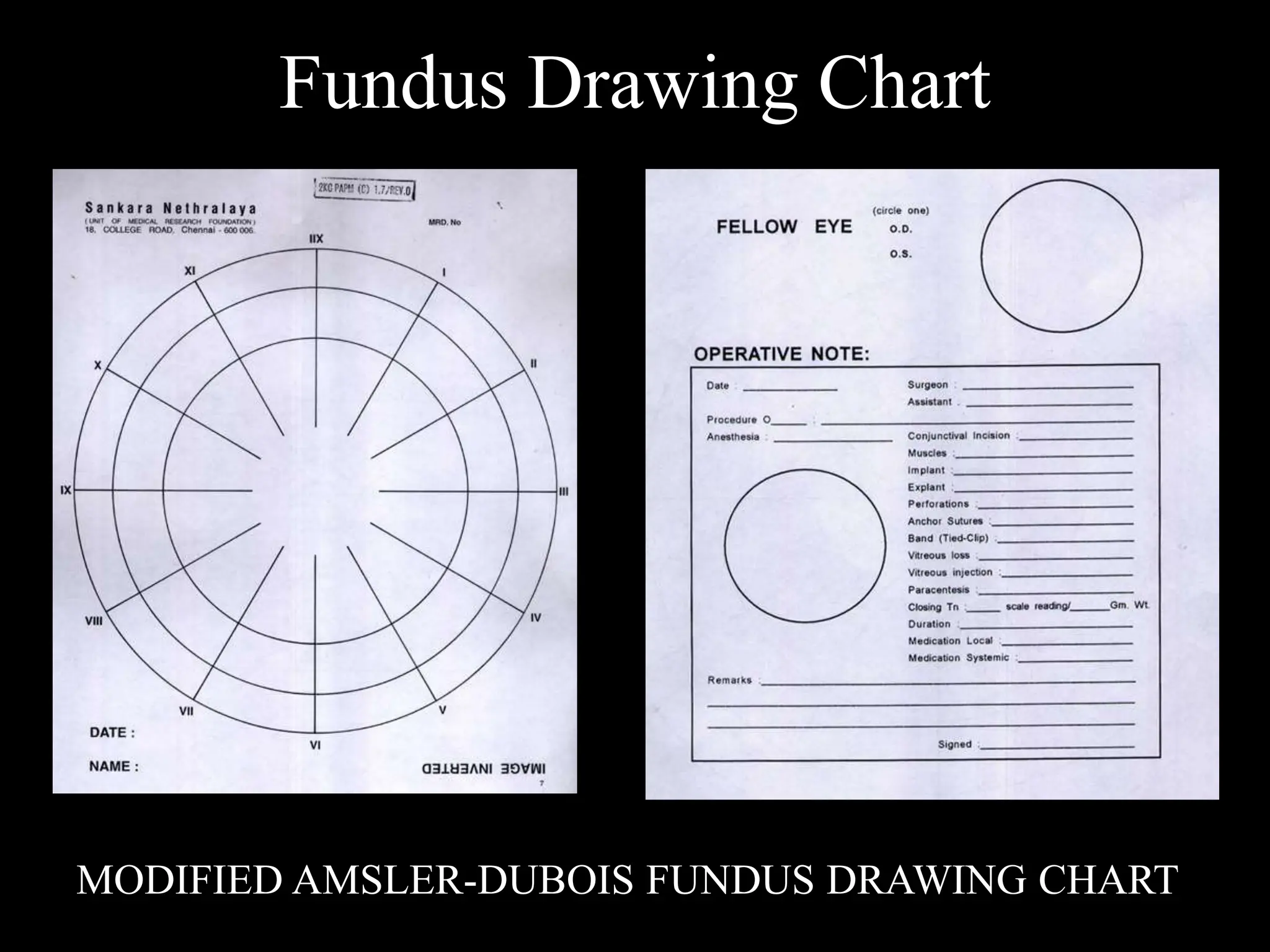 1FUNDUS_DRAWING of retina after complete examination | PPT