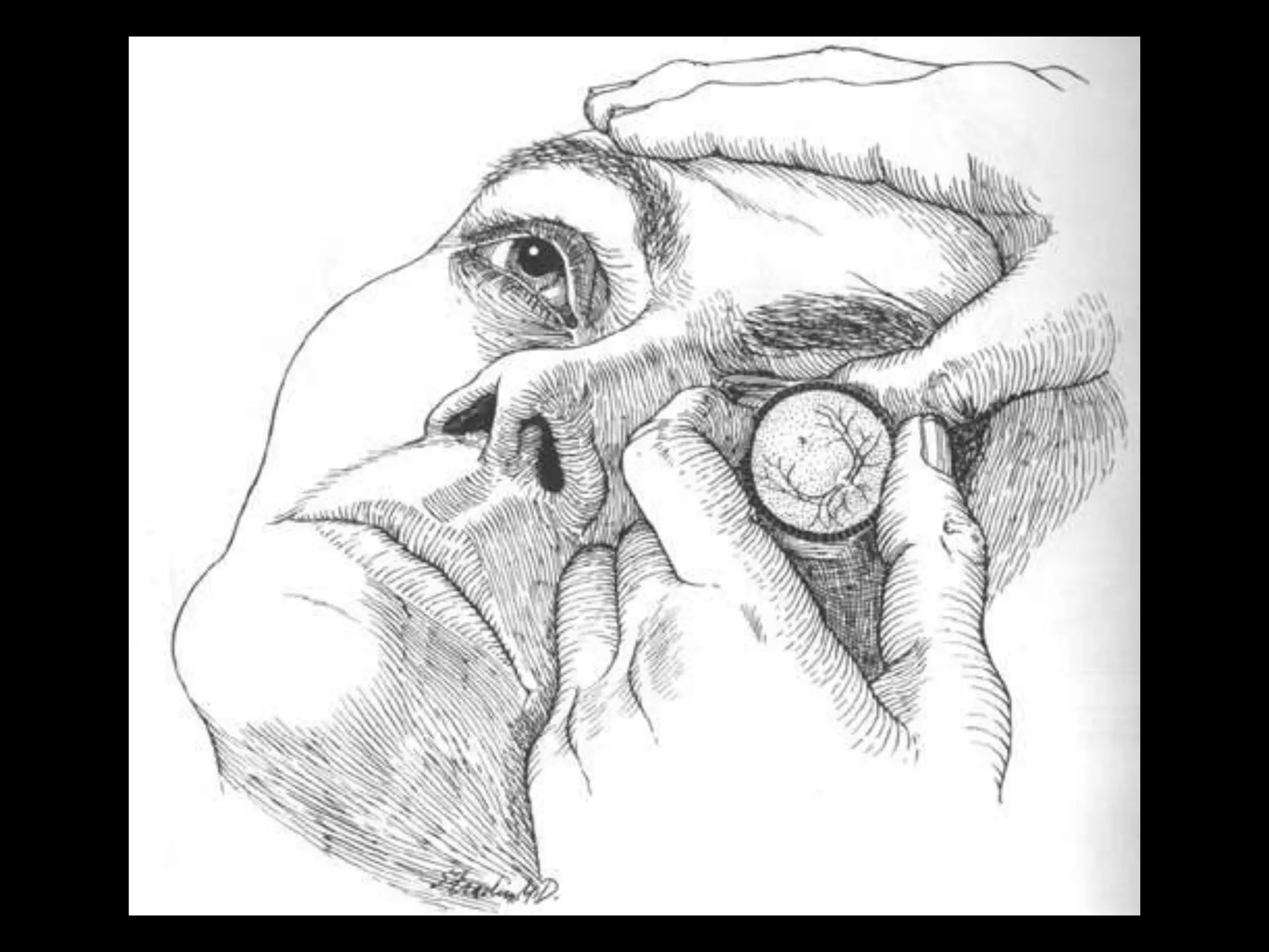 1FUNDUS_DRAWING of retina after complete examination | PPT