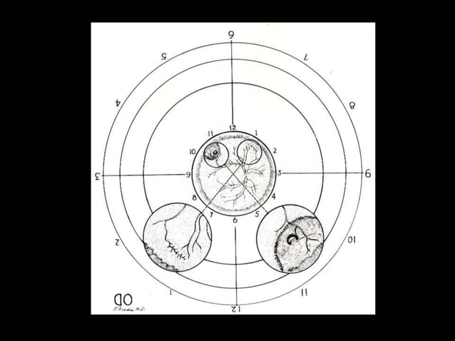 1FUNDUS_DRAWING of retina after complete examination | PPT | Eye and ...