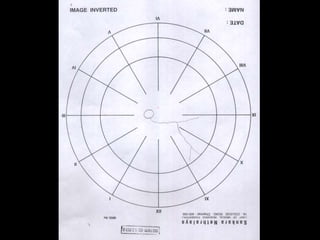 1FUNDUS_DRAWING of retina after complete examination | PPT | Eye and ...