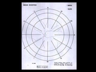 1FUNDUS_DRAWING of retina after complete examination | PPT | Eye and ...