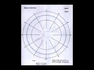 1FUNDUS_DRAWING of retina after complete examination | PPT | Eye and ...