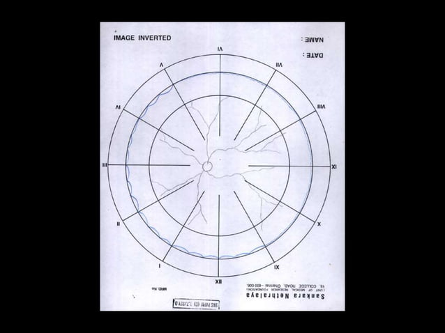 1FUNDUS_DRAWING of retina after complete examination | PPT | Eye and ...