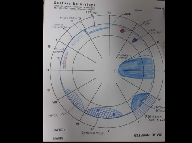 1FUNDUS_DRAWING of retina after complete examination | PPT | Eye and ...