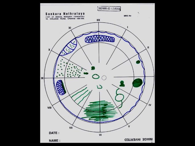1FUNDUS_DRAWING of retina after complete examination | PPT | Eye and ...