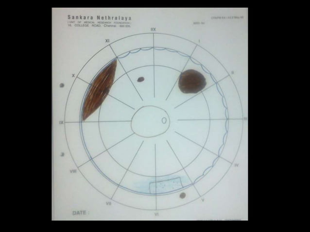 1FUNDUS_DRAWING of retina after complete examination | PPT | Eye and ...