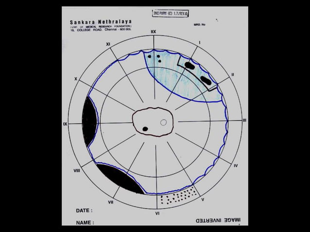 1FUNDUS_DRAWING of retina after complete examination | PPT | Eye and ...