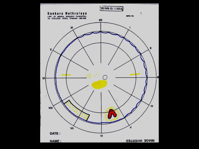 1FUNDUS_DRAWING of retina after complete examination | PPT | Eye and ...