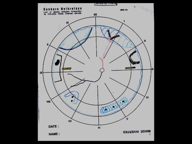 1FUNDUS_DRAWING of retina after complete examination | PPT | Eye and ...