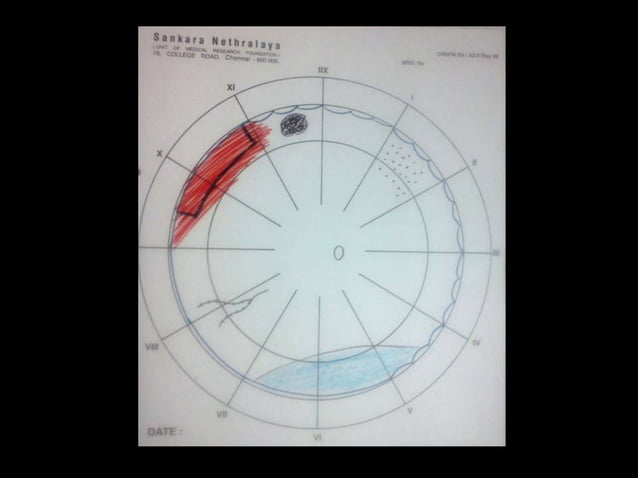 1FUNDUS_DRAWING of retina after complete examination | PPT | Eye and ...