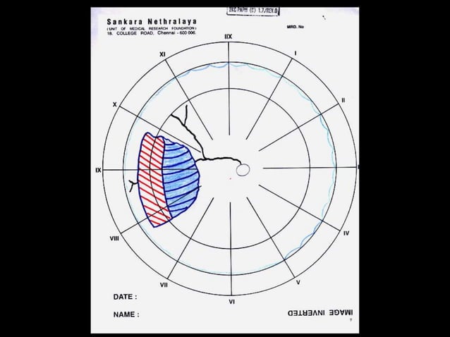 1FUNDUS_DRAWING of retina after complete examination | PPT | Eye and ...