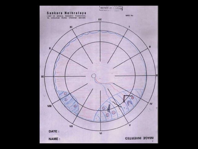 1FUNDUS_DRAWING of retina after complete examination | PPT | Eye and ...