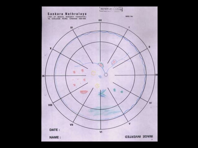 1FUNDUS_DRAWING of retina after complete examination | PPT | Eye and ...