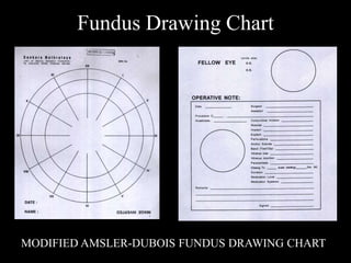 1FUNDUS_DRAWING of retina after complete examination | PPT | Eye and ...