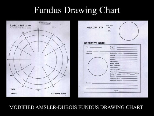 1FUNDUS_DRAWING of retina after complete examination | PPT | Eye and ...