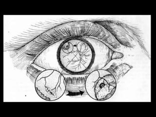 1FUNDUS_DRAWING of retina after complete examination | PPT | Eye and ...