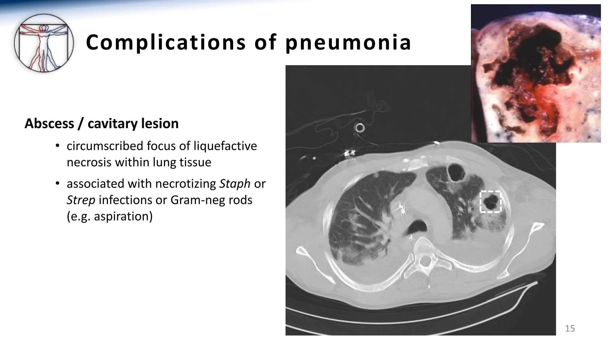 pneumonia.pptx