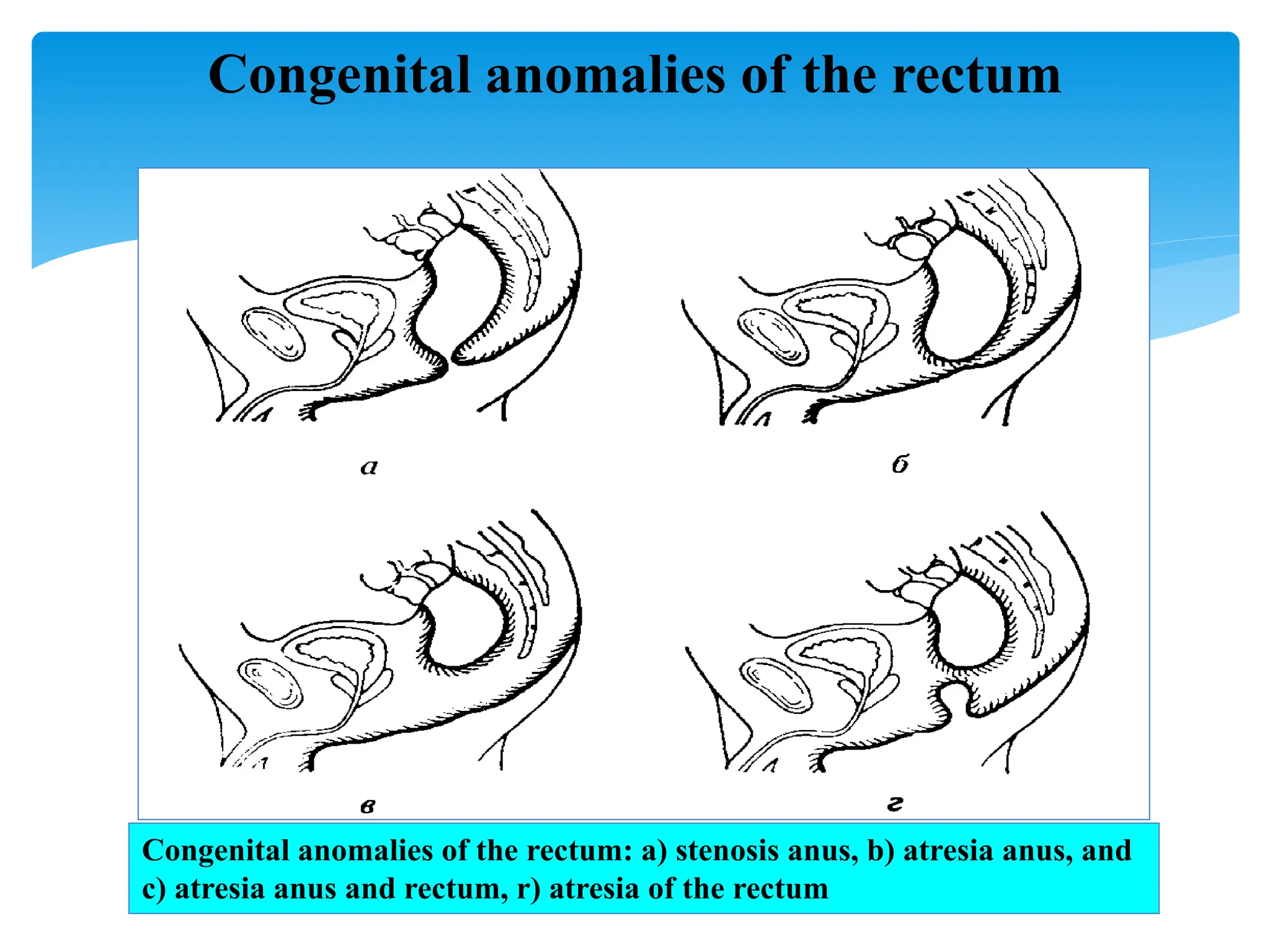 Rectal diseases. ..pptx | Pregnancy | Reproductive Health