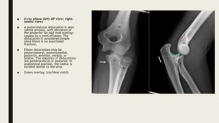 Upper Extremities injury. .pptx
