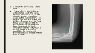 Upper Extremities injury. .pptx