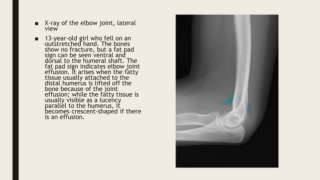 Upper Extremities injury. .pptx