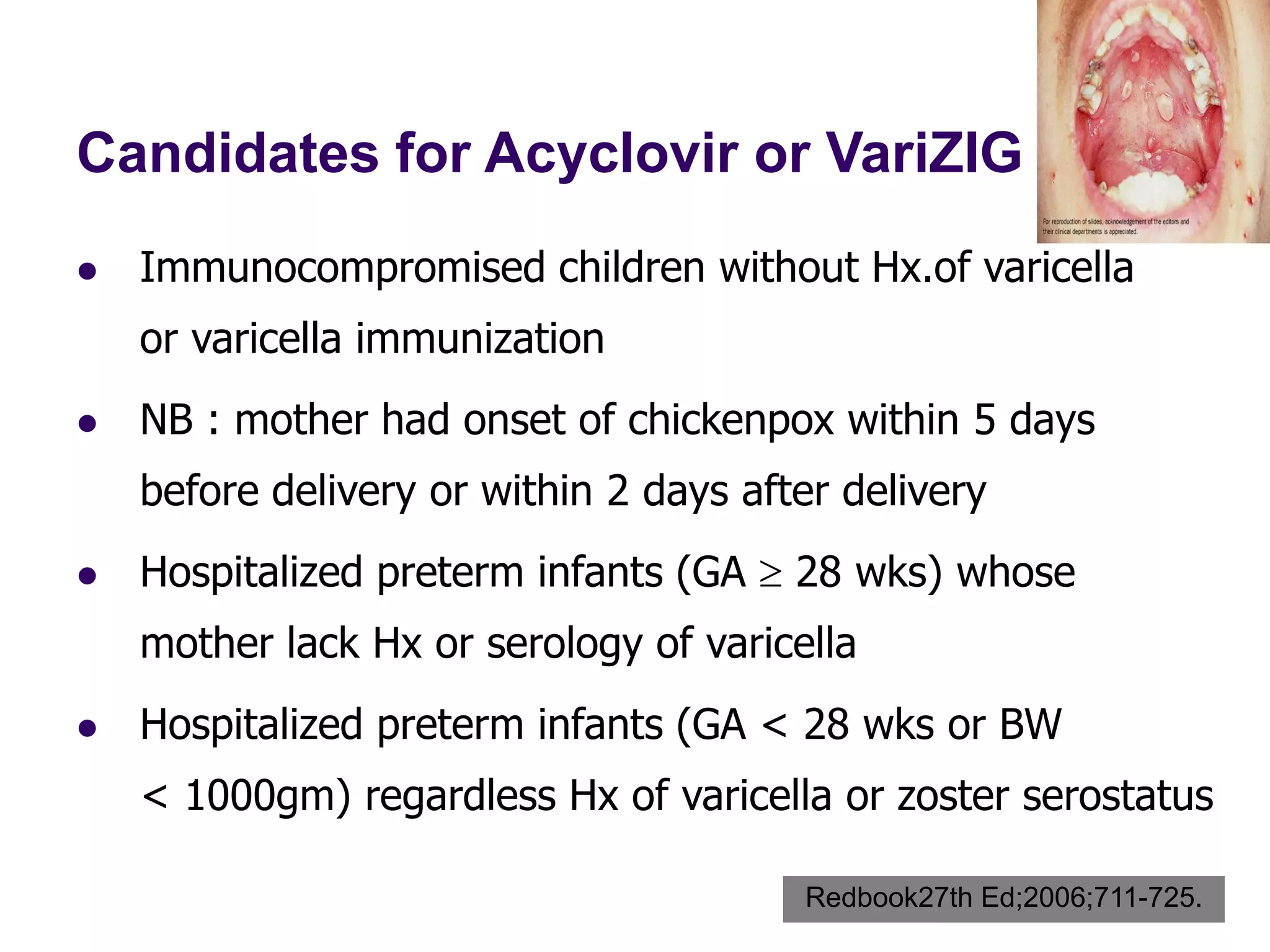 Varicella zoster virus | PDF