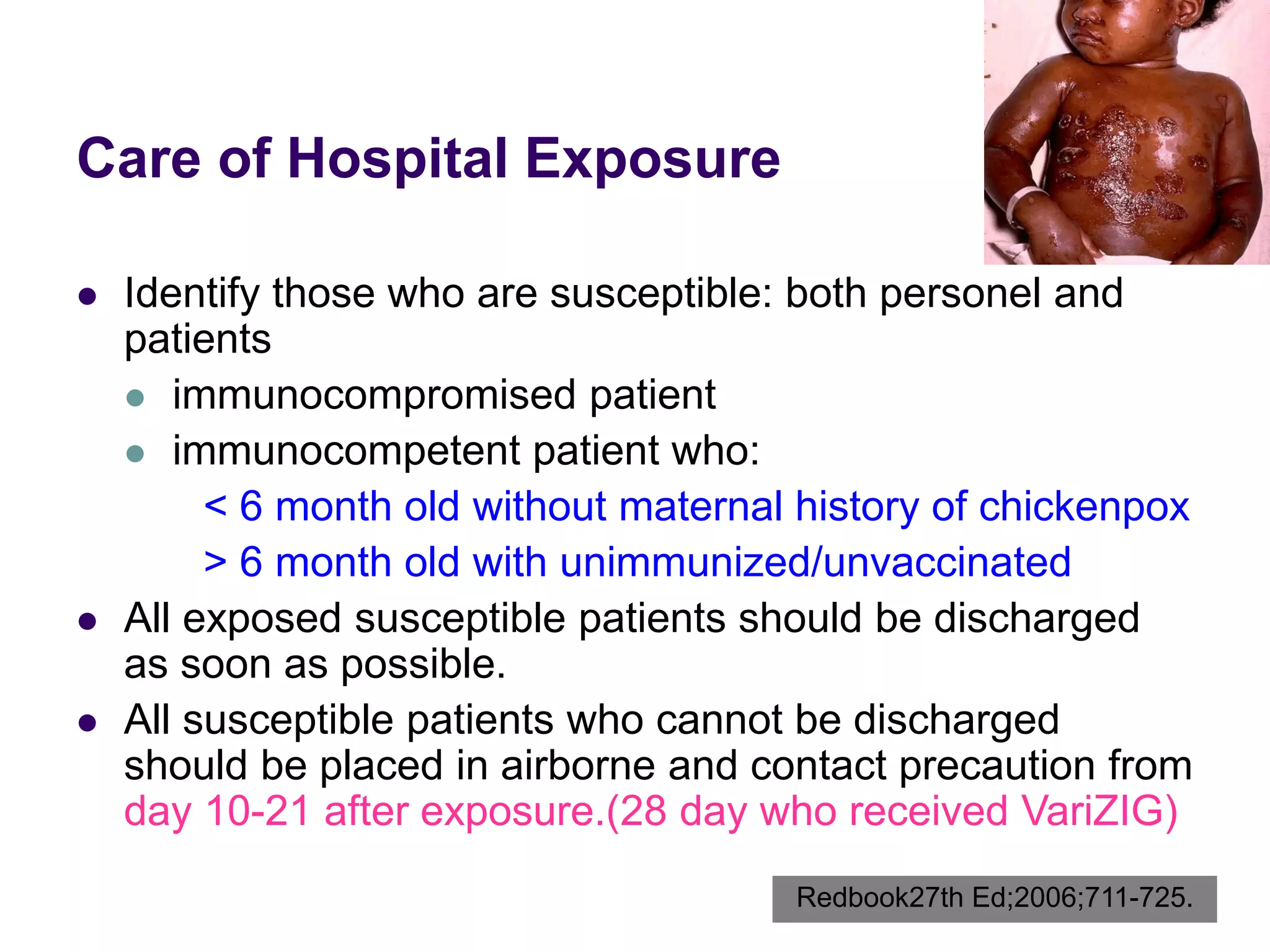 Varicella zoster virus | PDF