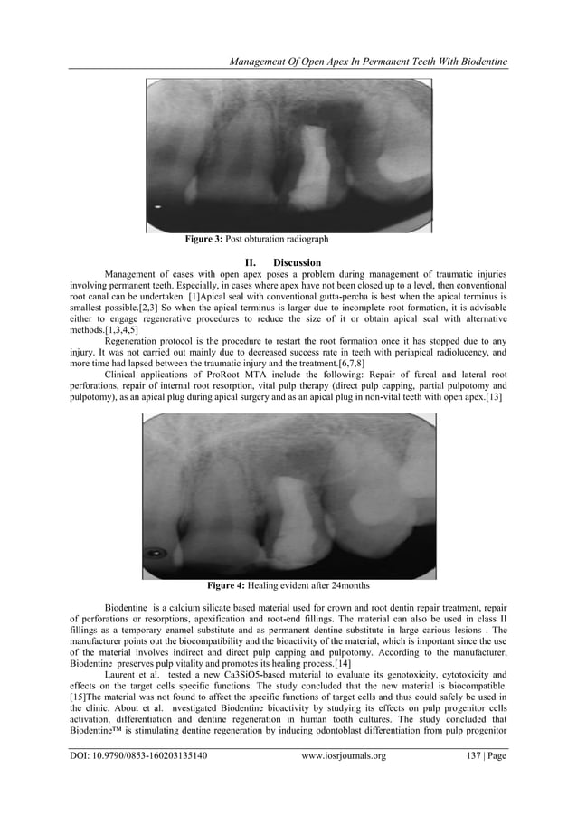 Management of Open Apex in Permanent Teeth with Biodentine | PDF