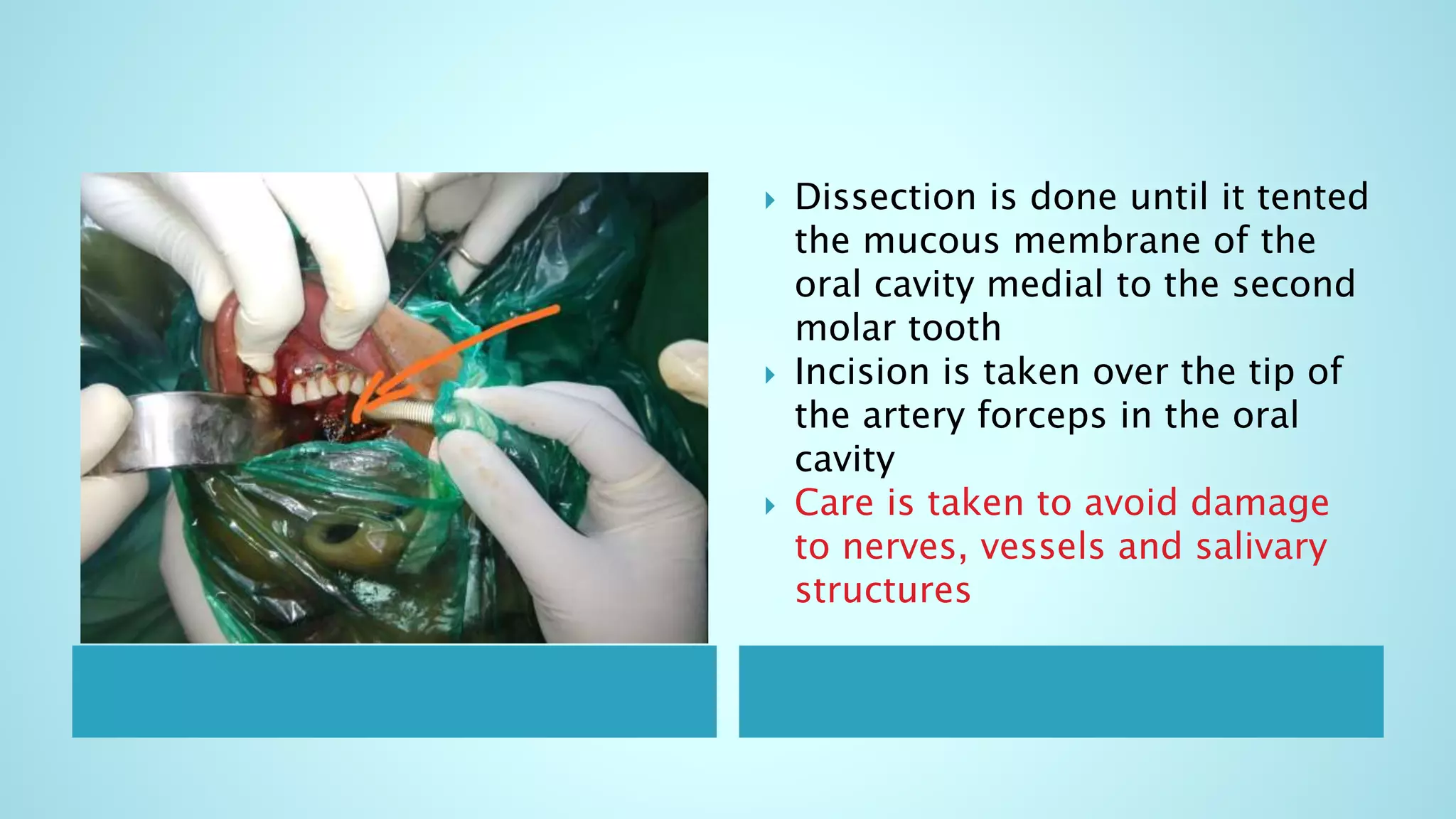 SUBMENTAL INTUBATION.pptx