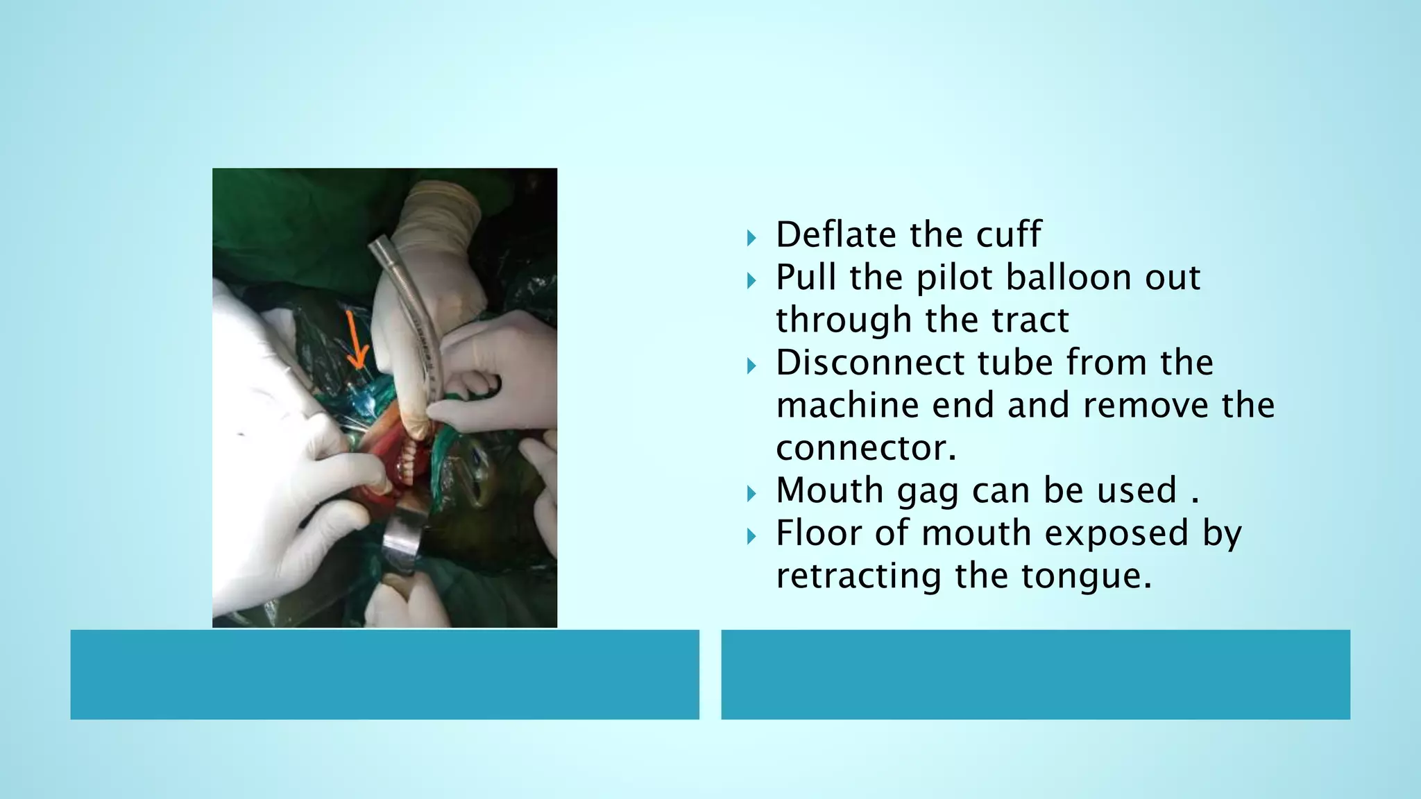 SUBMENTAL INTUBATION.pptx