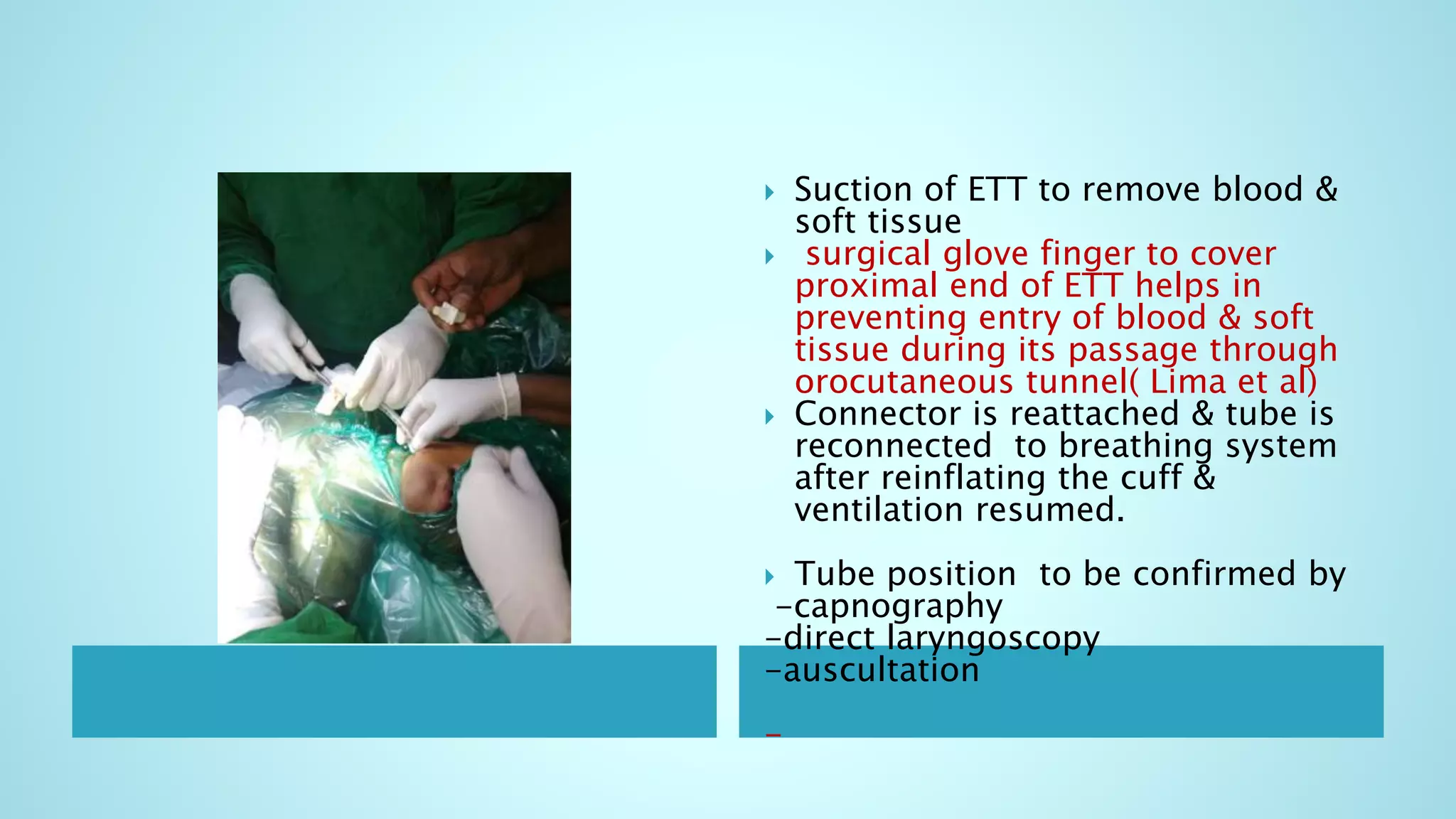 SUBMENTAL INTUBATION.pptx