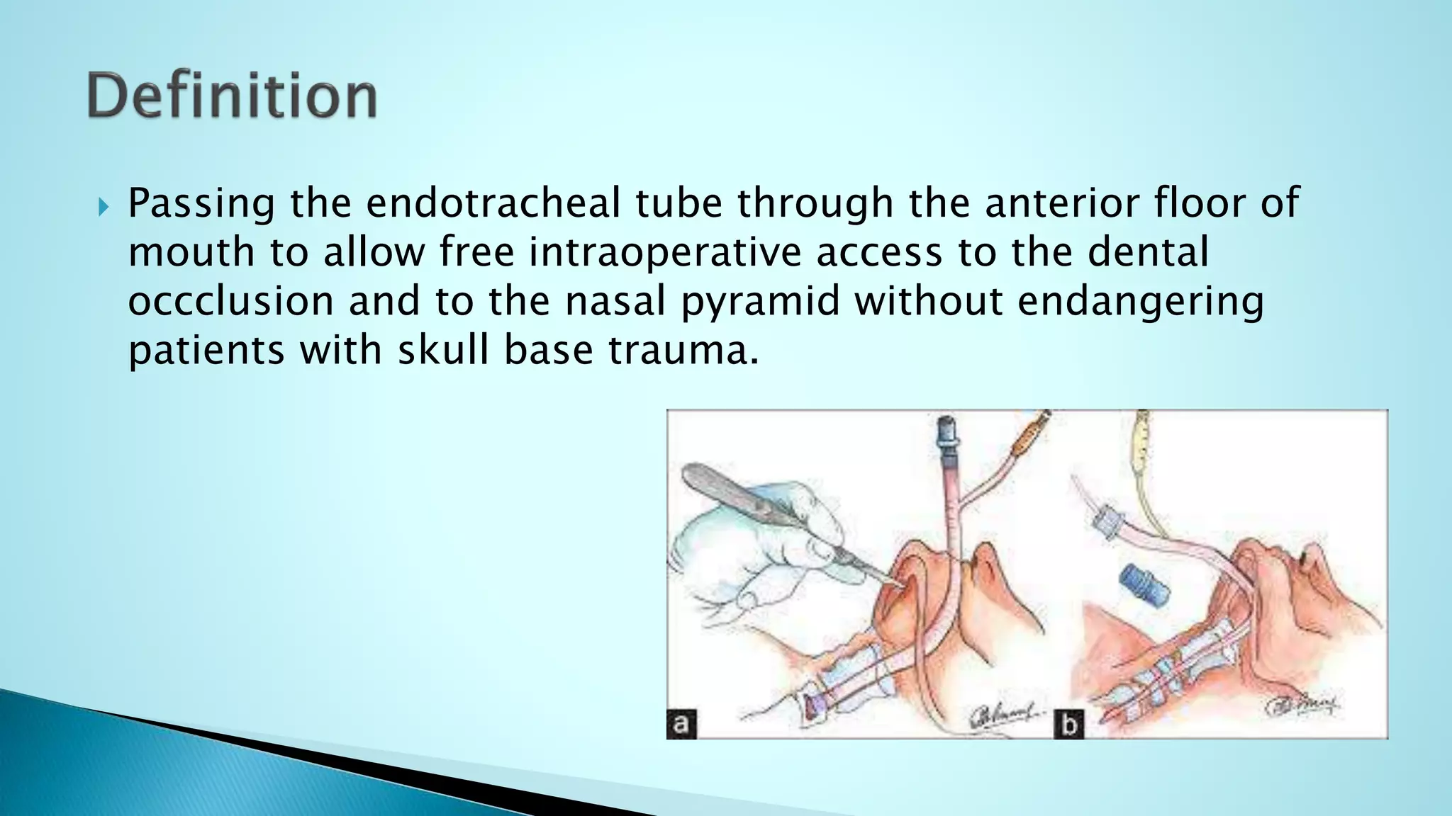 SUBMENTAL INTUBATION.pptx