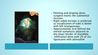SUBMENTAL INTUBATION.pptx