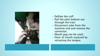 SUBMENTAL INTUBATION.pptx