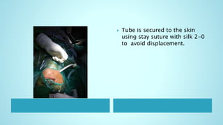 SUBMENTAL INTUBATION.pptx