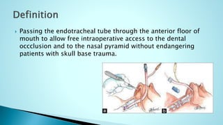 SUBMENTAL INTUBATION.pptx