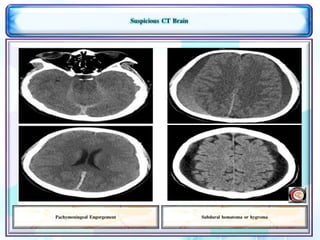 Spontaneous intracranial hypotension | PPTX
