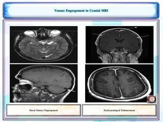 Spontaneous intracranial hypotension | PPTX
