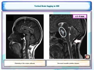 Spontaneous intracranial hypotension | PPTX