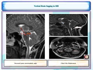 Spontaneous intracranial hypotension | PPTX