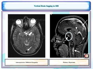 Spontaneous intracranial hypotension | PPTX