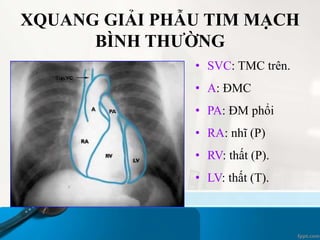 X QUANG NGỰC THẲNG TRONG BỆNH LÝ TIM MẠCH | PPT