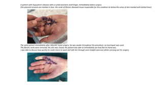WALANT: wide awake local anaesthetic no tourniquet hand surgery | PPTX