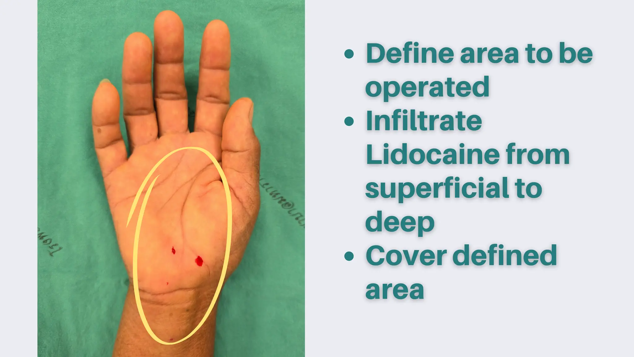 Wide Awake Local Anesthesia No Tourniquet in Orthopaedic Surgery | PDF