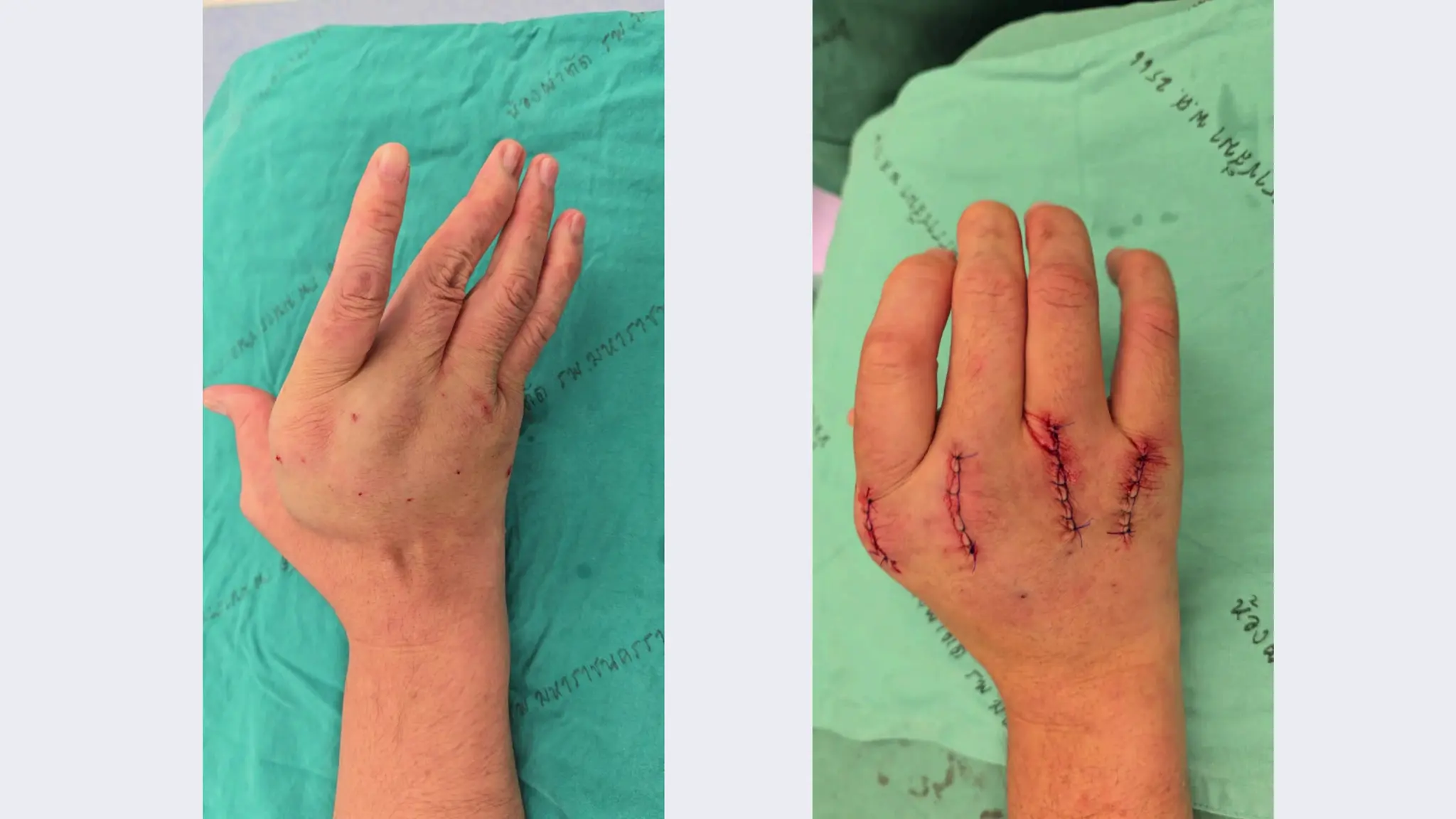 Wide Awake Local Anesthesia No Tourniquet in Orthopaedic Surgery | PDF