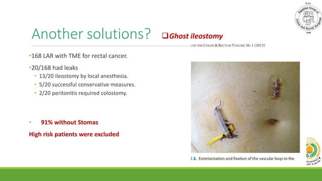 Colostomy & Ileostomy | PDF