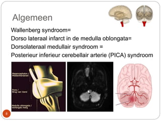 Wallenberg syndroom presentatie definitief.pptx